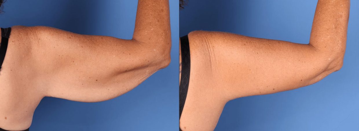 Arm lift Surgery in Dubai - Arm Fat Removal - Arm Reduction Surgery