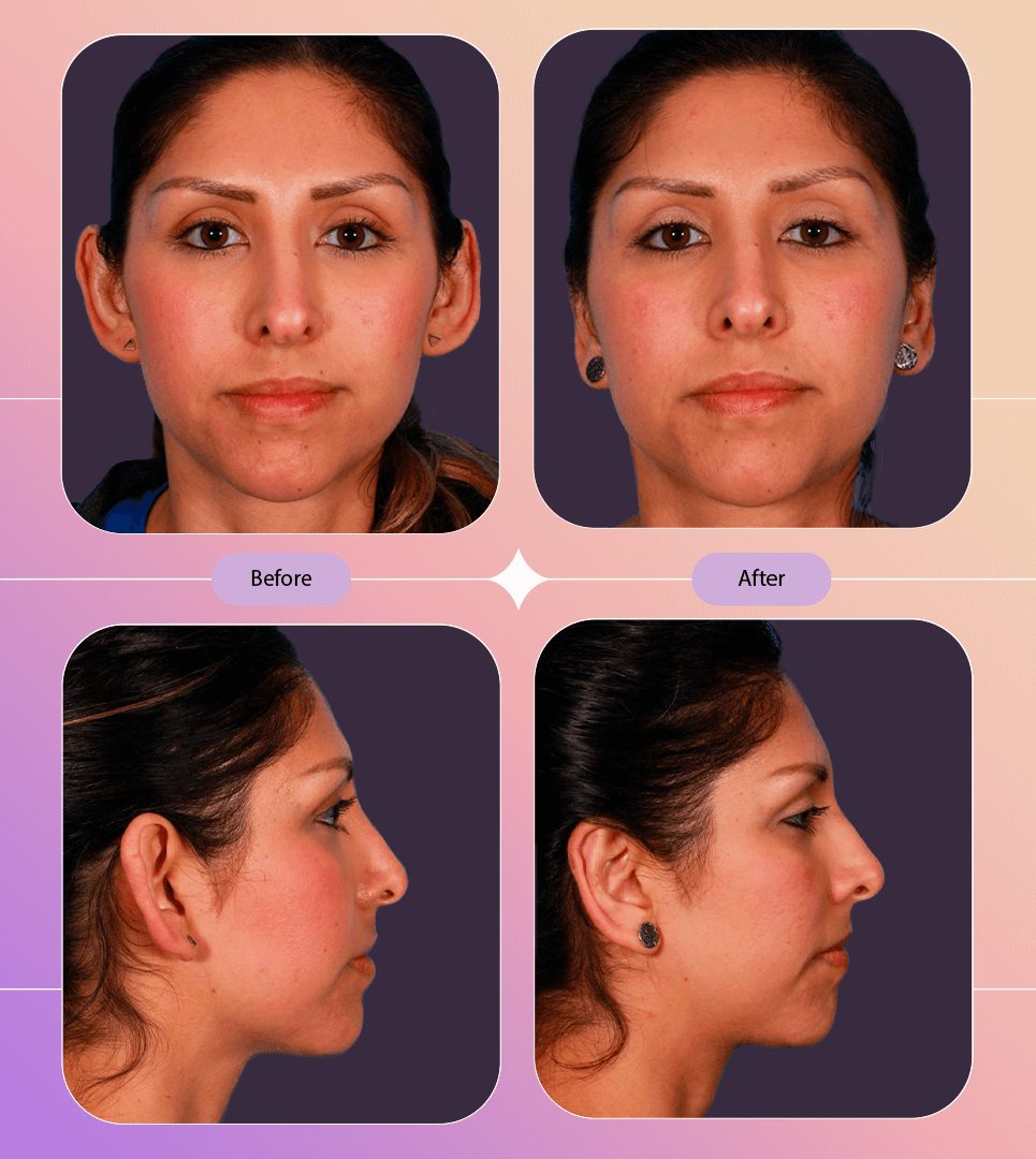 Otoplasty in Dubai - Best Otoplasty Dubai, UAE - Ear Reshaping Surgery ...