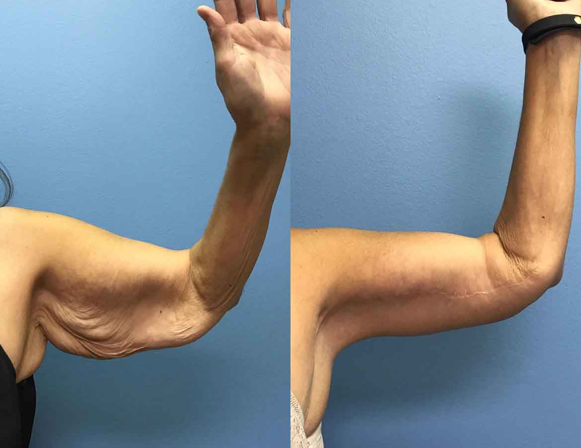 Arm lift Surgery in Dubai - Arm Fat Removal - Arm Reduction Surgery