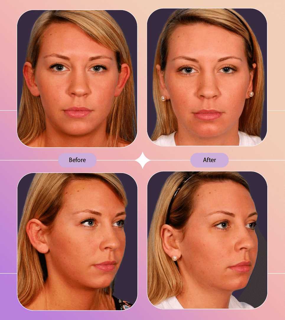 Otoplasty in Dubai - Best Otoplasty Dubai, UAE - Ear Reshaping Surgery ...