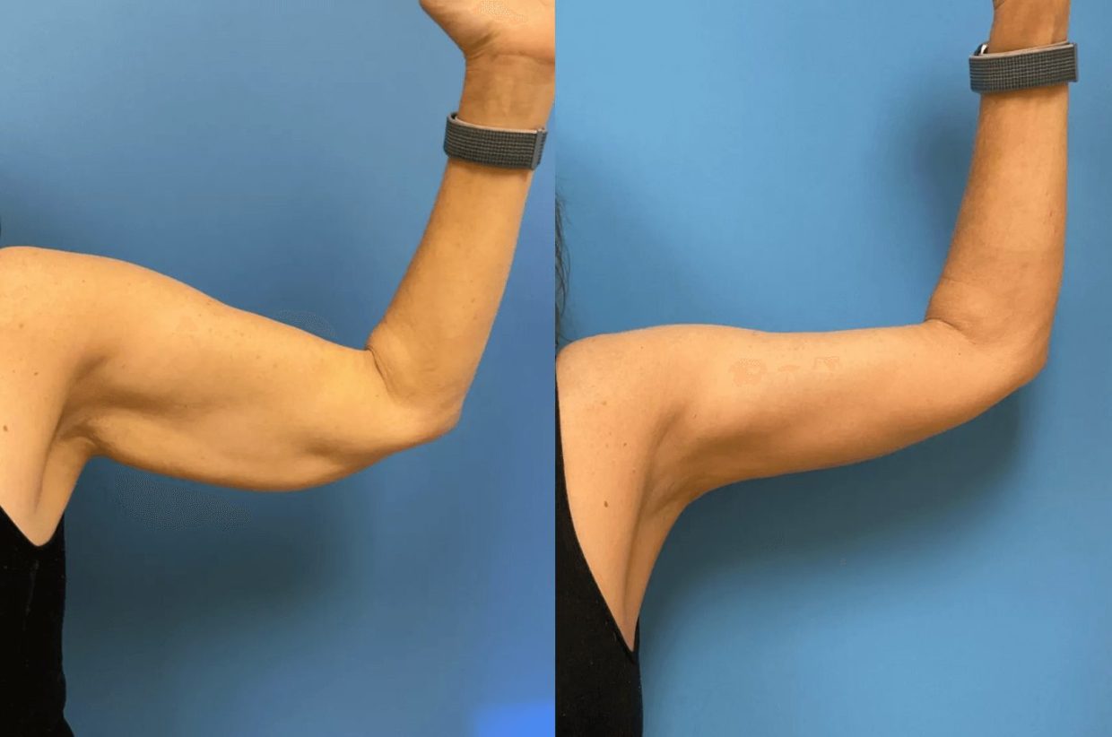 Arm lift Surgery in Dubai - Arm Fat Removal | Novomed