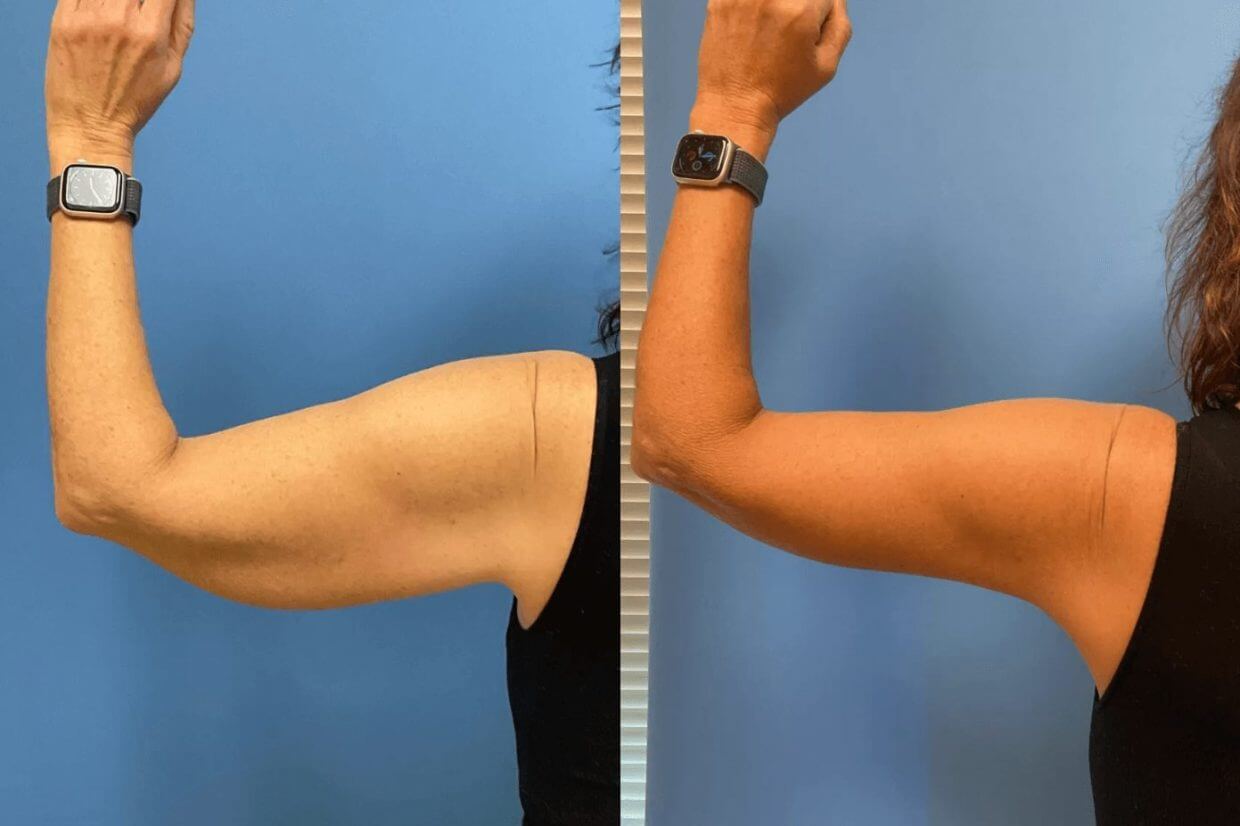Arm lift Surgery in Dubai - Arm Fat Removal - Arm Reduction Surgery