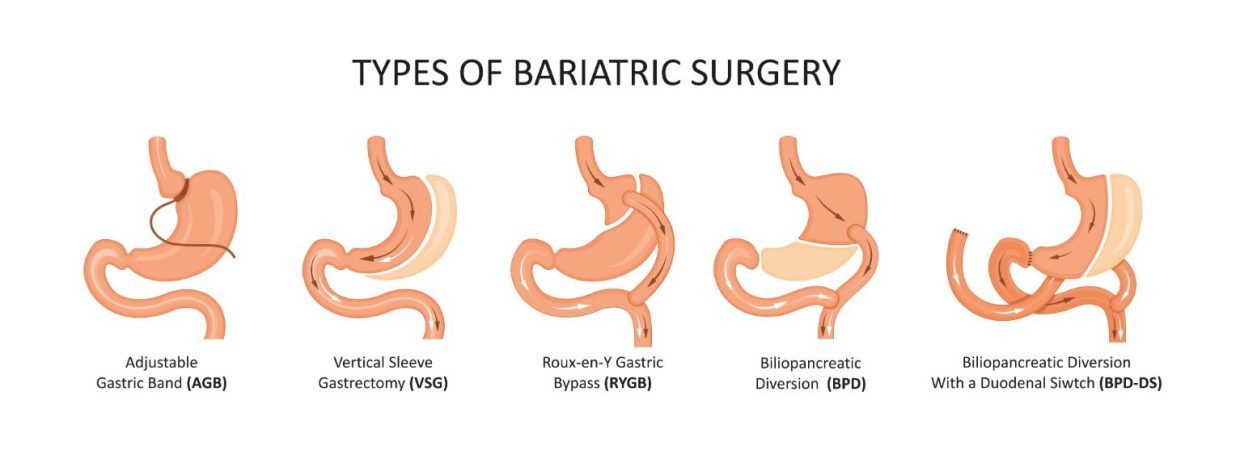 Gastric Revisional Surgery in Dubai